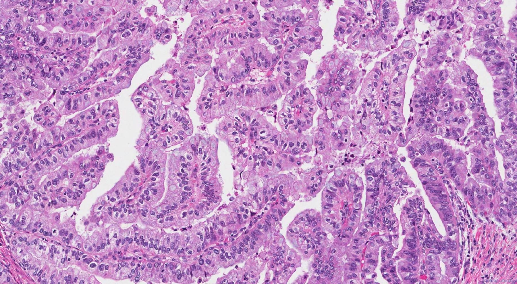 Stage 4 Adenocarcinoma Of The Ampulla