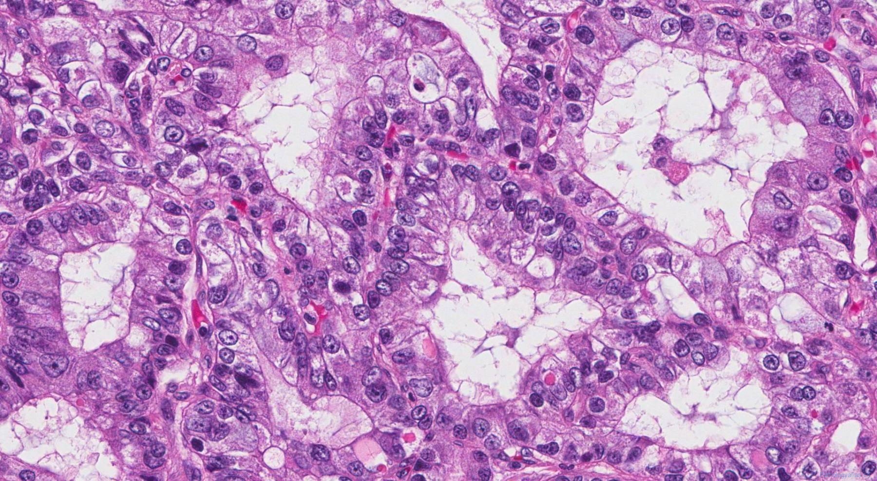 Stage 4 Adenocarcinoma Of The Lung Icd 10
