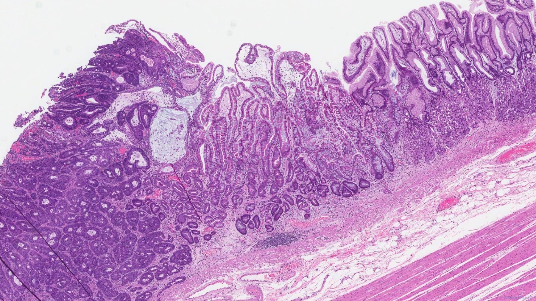 intestinal metaplasia Archives | Ottawa Atlas of Pathology
