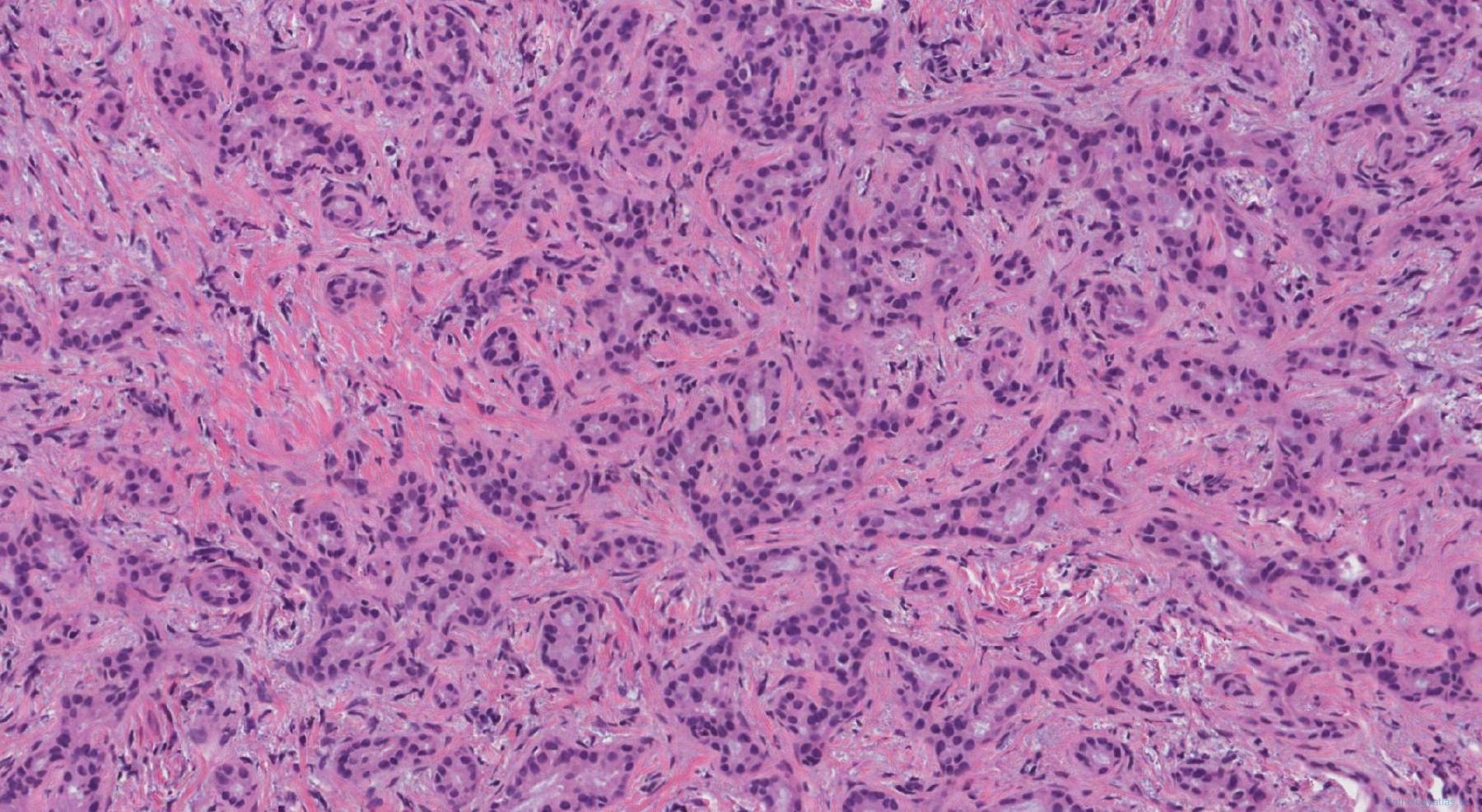 Bile duct adenoma | Ottawa Atlas of Pathology Bile duct adenoma | Ottawa Atlas of Pathology