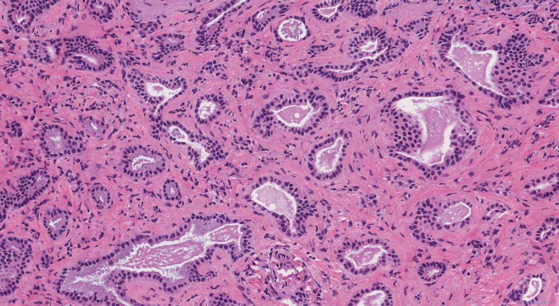 Bile duct adenoma | Ottawa Atlas of Pathology Bile duct adenoma | Ottawa Atlas of Pathology
