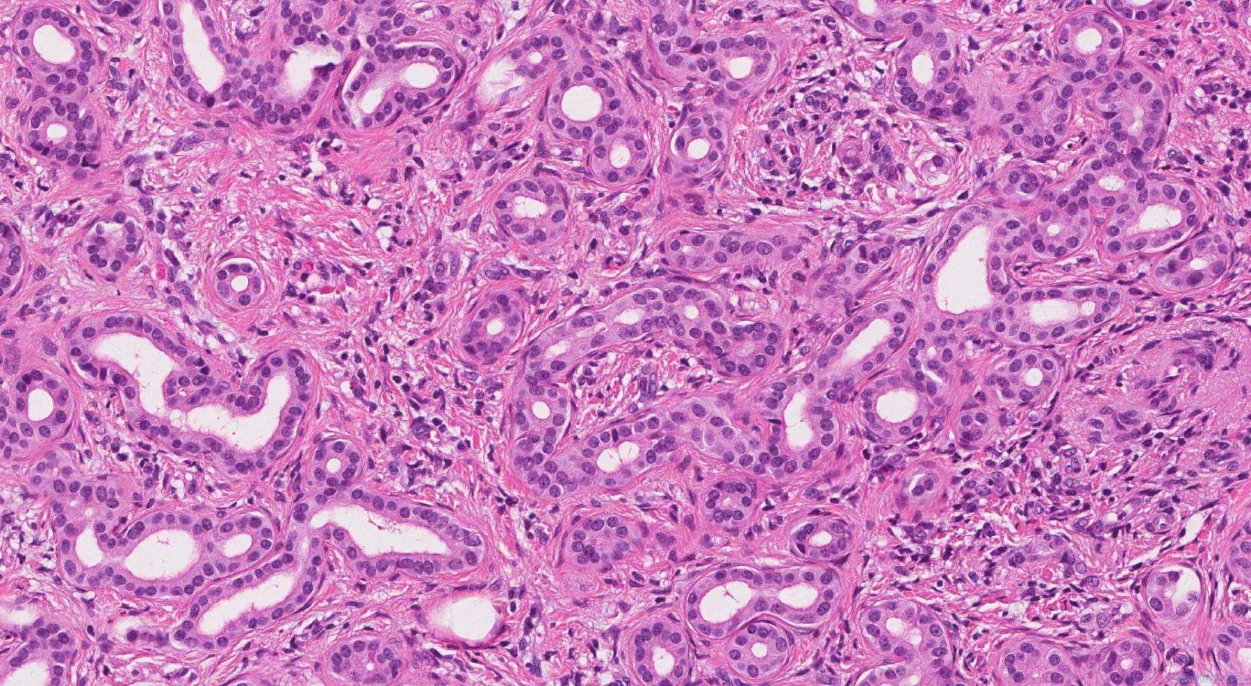 Bile duct adenoma | Ottawa Atlas of Pathology Bile duct adenoma | Ottawa Atlas of Pathology