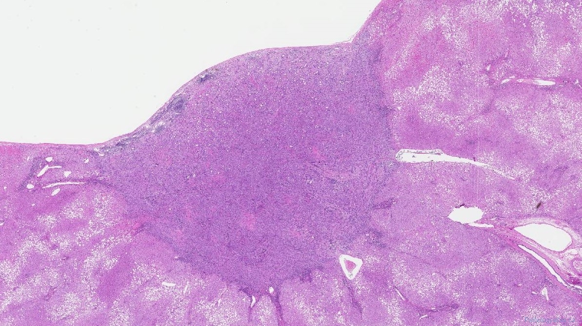 Bile duct adenoma | Ottawa Atlas of Pathology Bile duct adenoma | Ottawa Atlas of Pathology