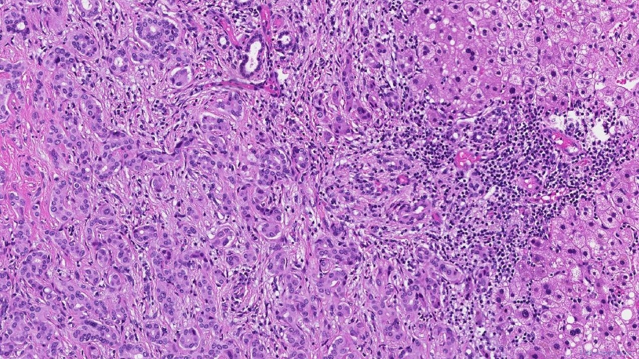 Bile duct adenoma | Ottawa Atlas of Pathology Bile duct adenoma | Ottawa Atlas of Pathology