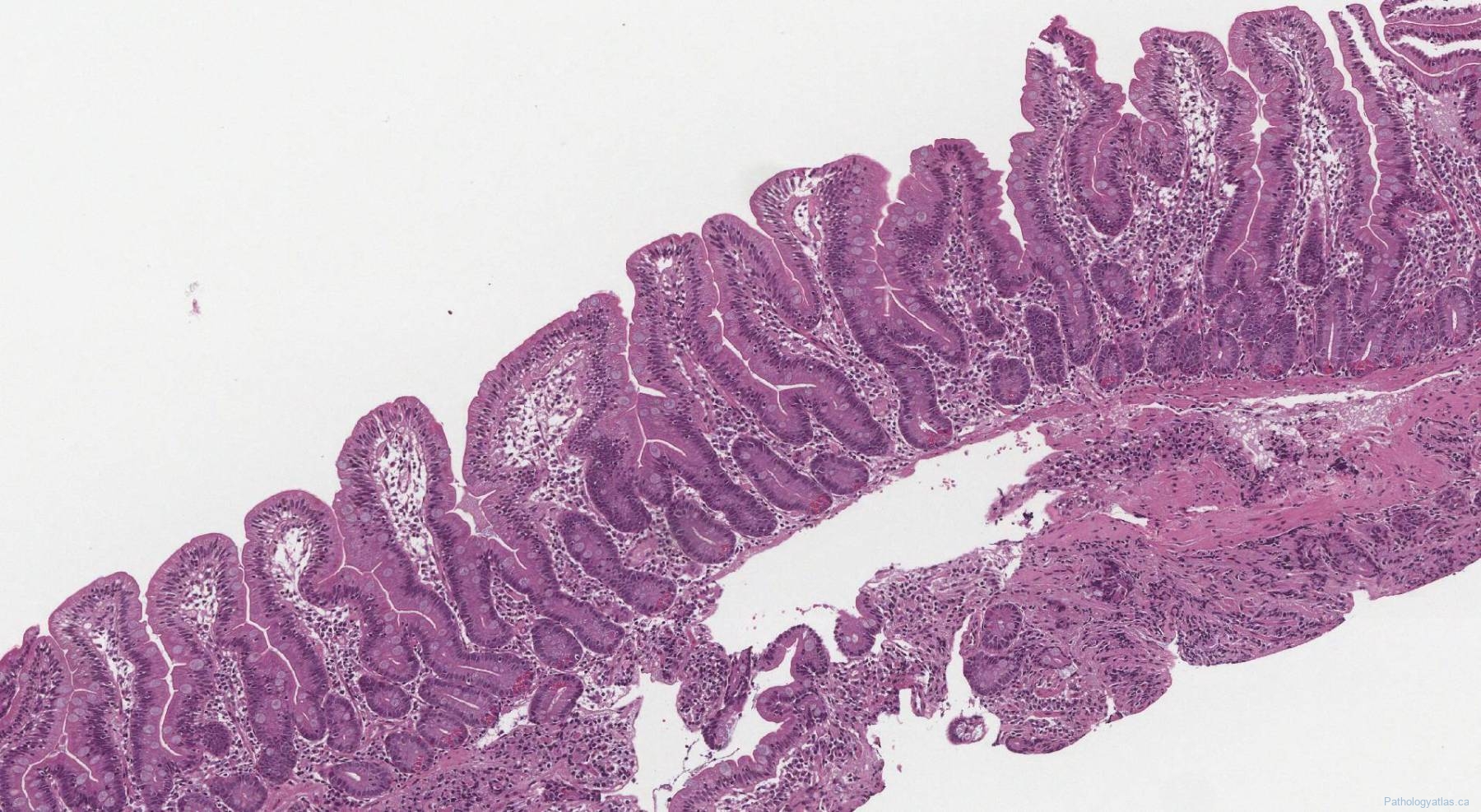 celiac disease Archives | Ottawa Atlas of Pathology