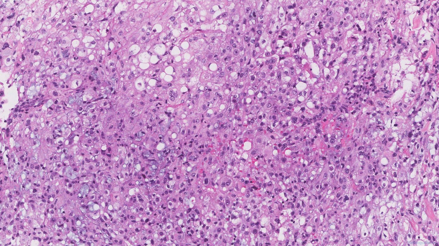 physaliferous cells Archives | Ottawa Atlas of Pathology