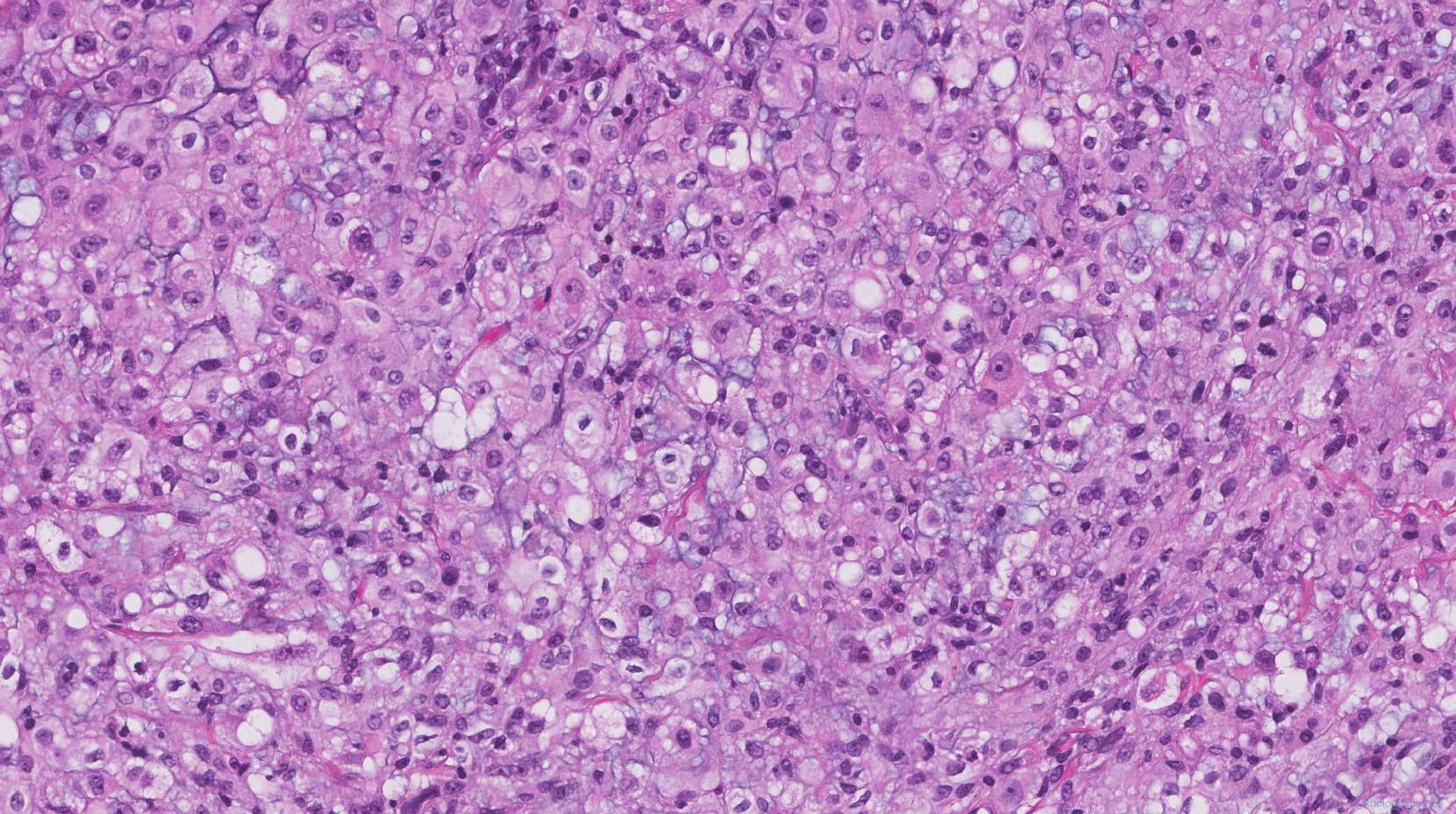 physaliferous cells Archives | Ottawa Atlas of Pathology