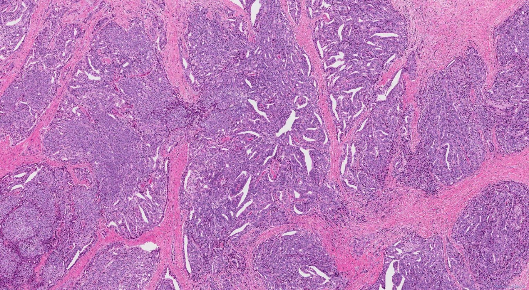 Ductal Adenocarcinoma Of The Prostate Gland Ottawa Atlas Of Pathology