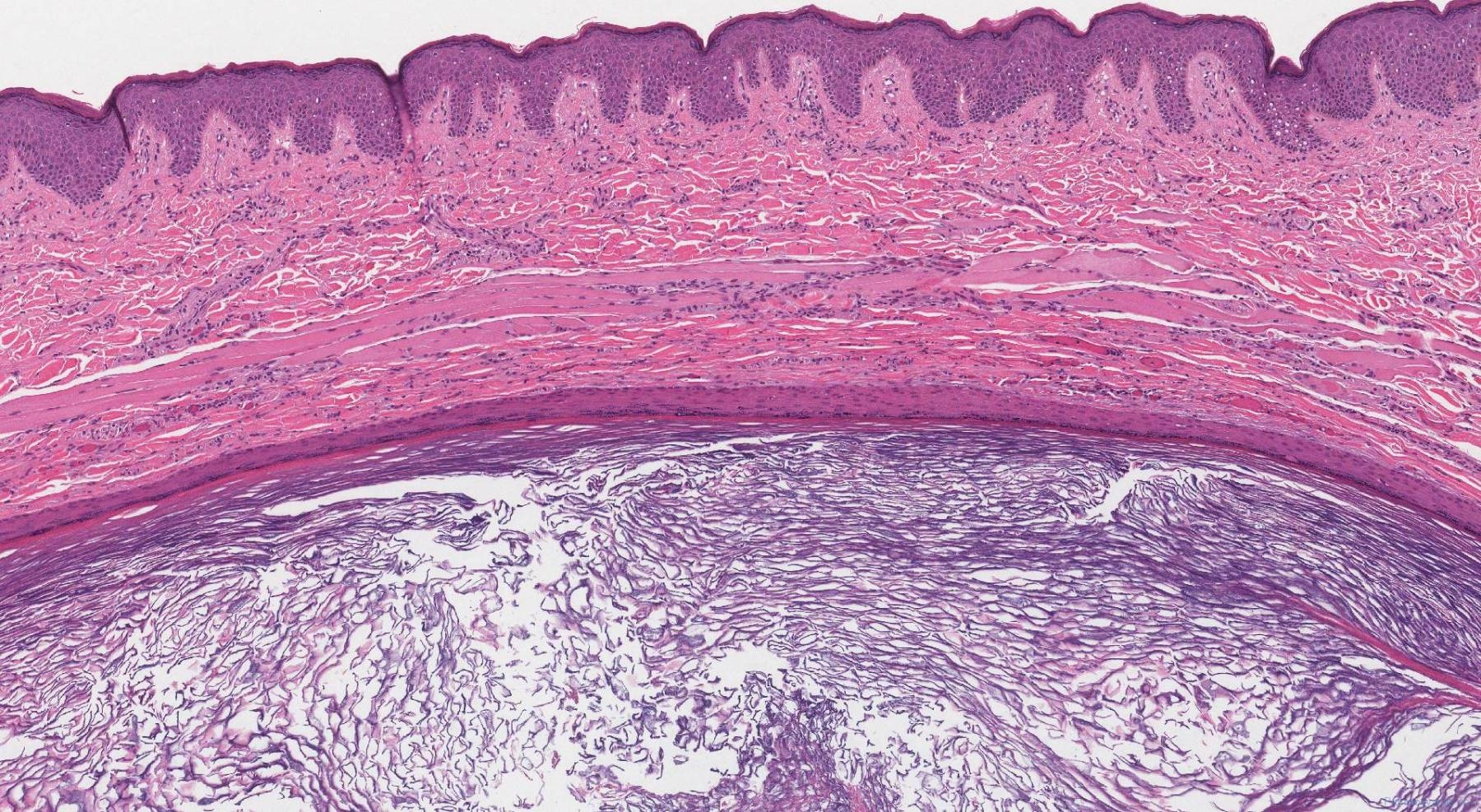 Epidermoid Cyst Ottawa Atlas Of Pathology Epidermoid Cyst Ottawa Atlas Of Pathology