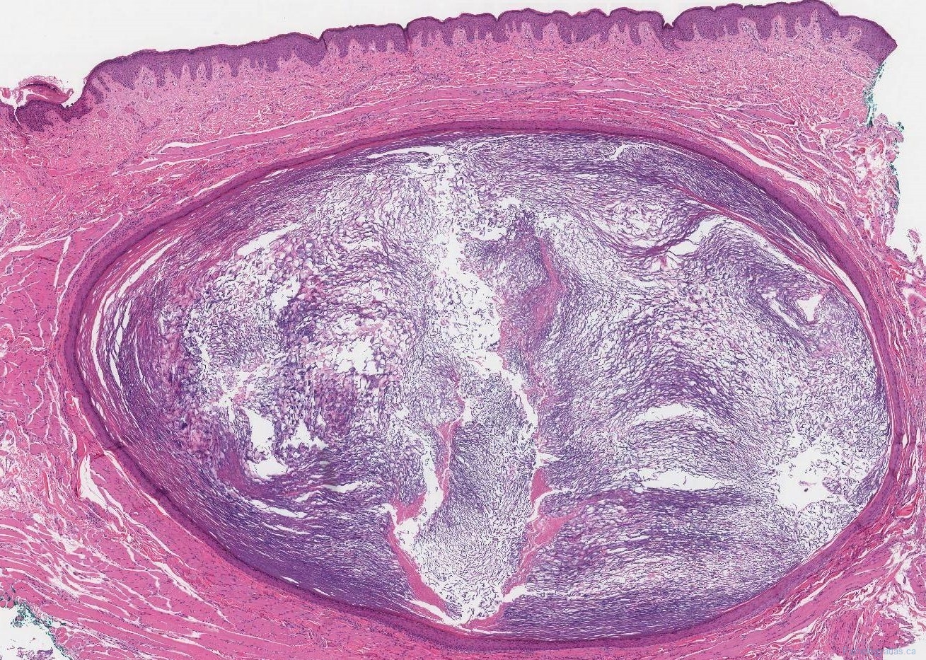 Epidermoid Cyst Ottawa Atlas Of Pathology Epidermoid Cyst Ottawa Atlas Of Pathology