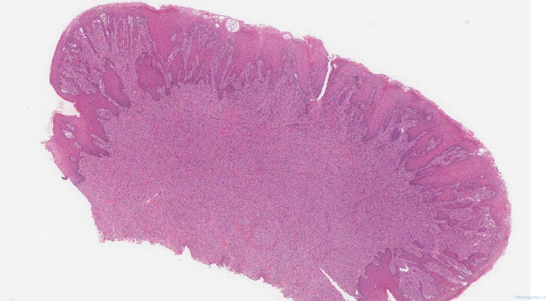 Pseudoepitheliomatous Hyperplasia _ Pseudoepitheliomatous Hyperplasia ...