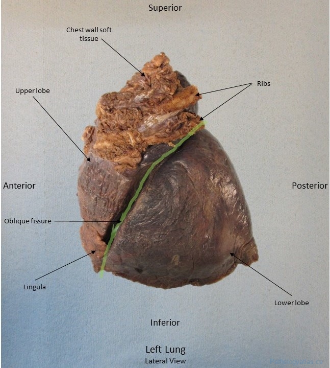 pneumonectomy Archives | Atlas of Pathology
