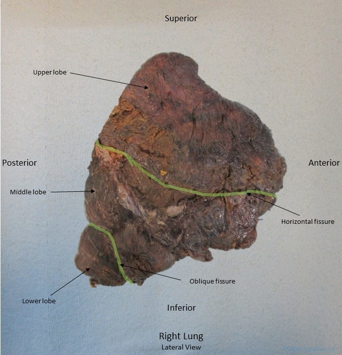 pneumonectomy Archives | Atlas of Pathology