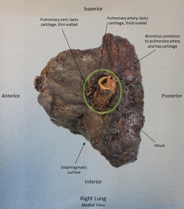 pneumonectomy Archives | Atlas of Pathology