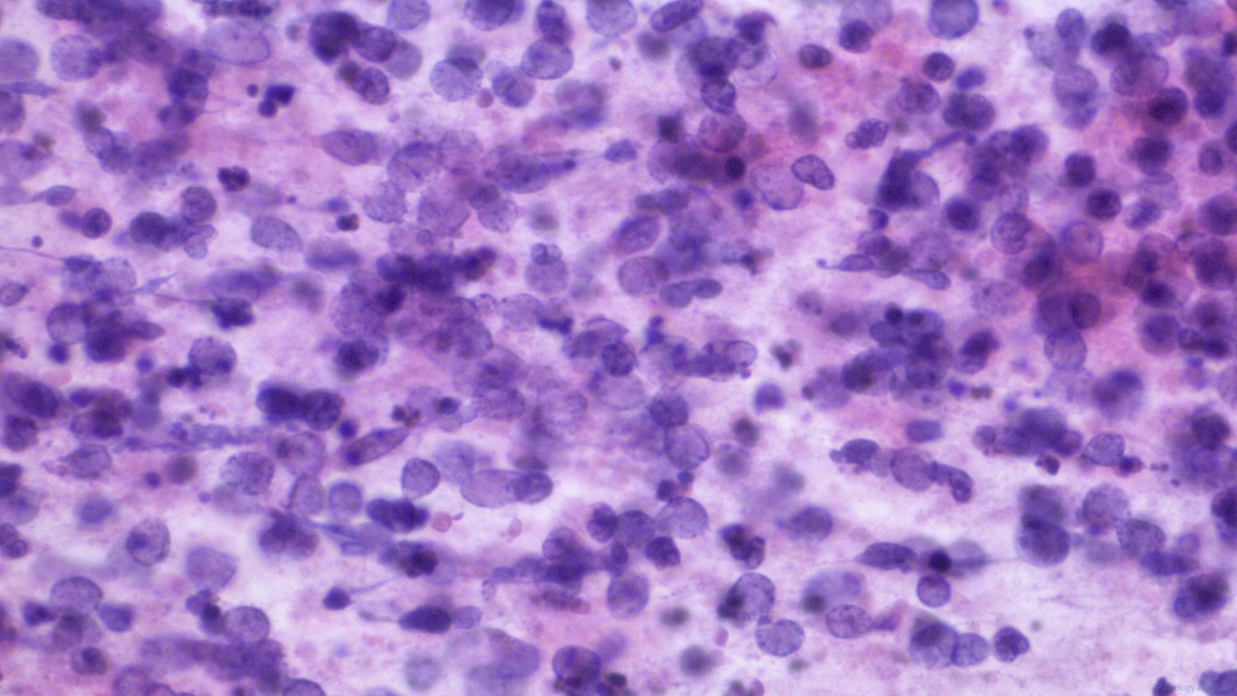 hematolymphoid Archives | Atlas of Pathology