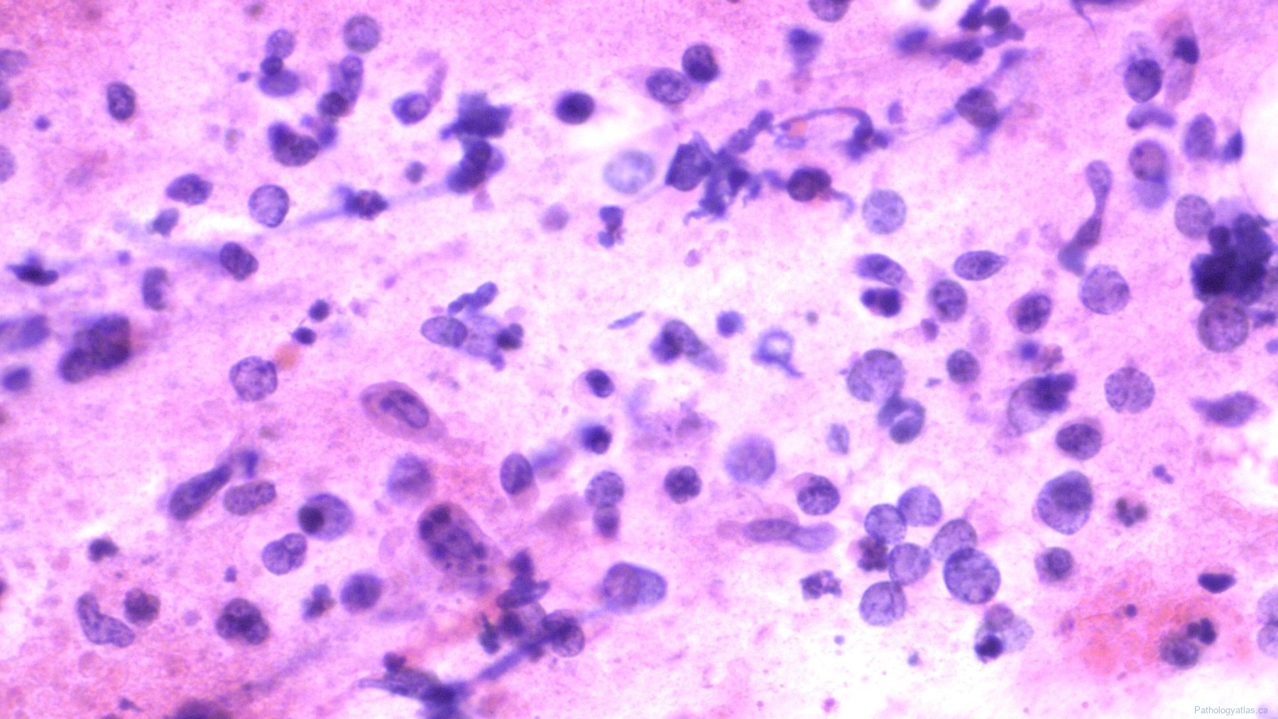 hematolymphoid Archives | Atlas of Pathology