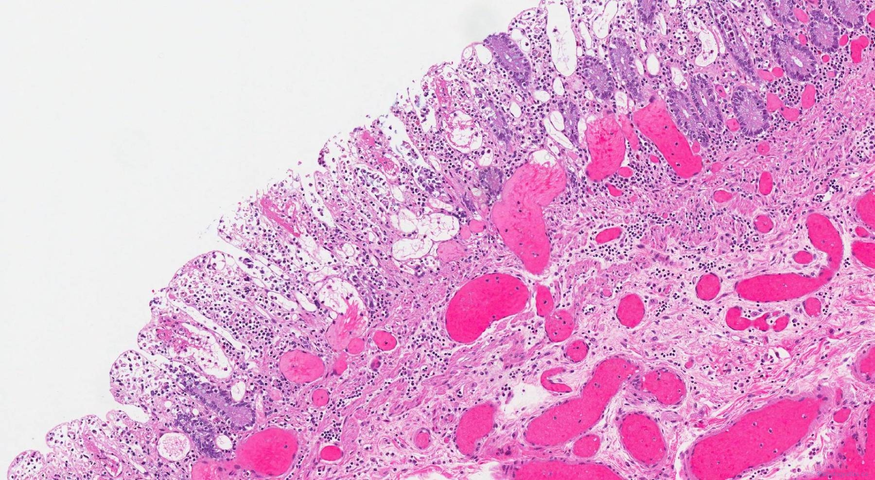 Ischemic colitis | Atlas of Pathology Ischemic colitis | Atlas of Pathology