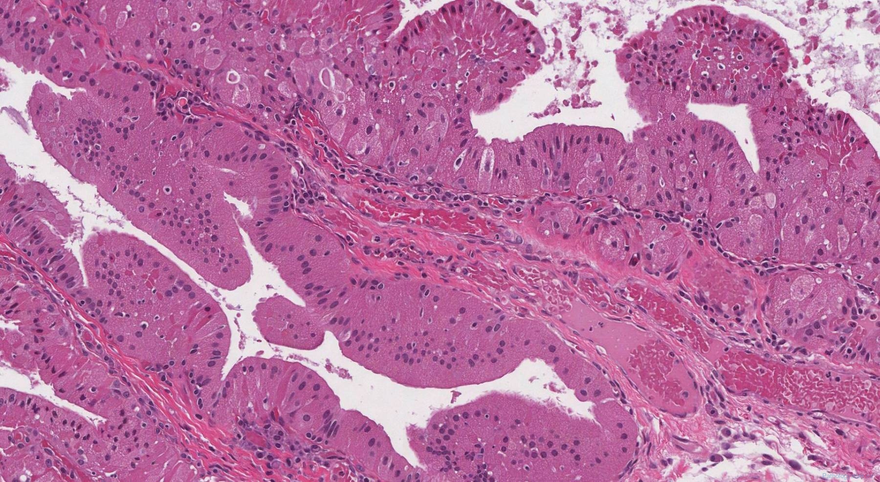 Saccular Cyst Archives Ottawa Atlas Of Pathology Saccular Cyst Archives Ottawa Atlas Of Pathology