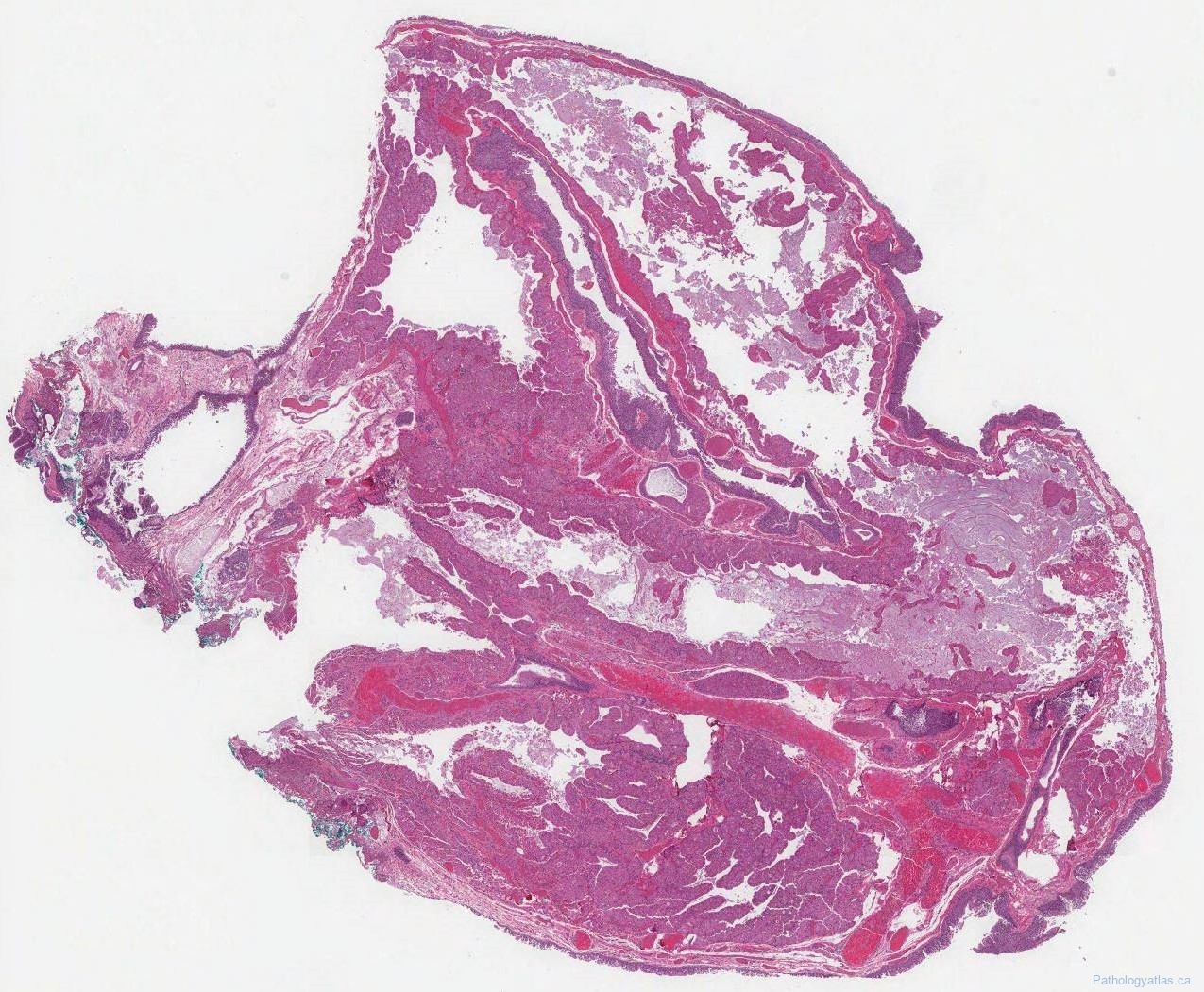 Saccular Cyst Archives Ottawa Atlas Of Pathology Saccular Cyst Archives Ottawa Atlas Of Pathology