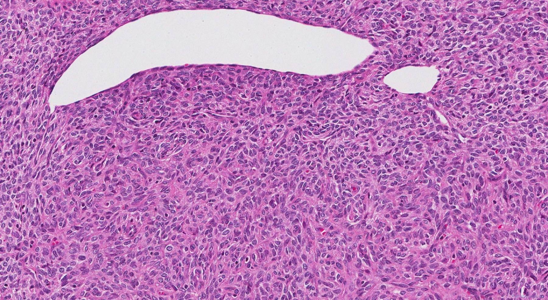 Low Grade Endometrial Stromal Sarcoma Ottawa Atlas Of Pathology
