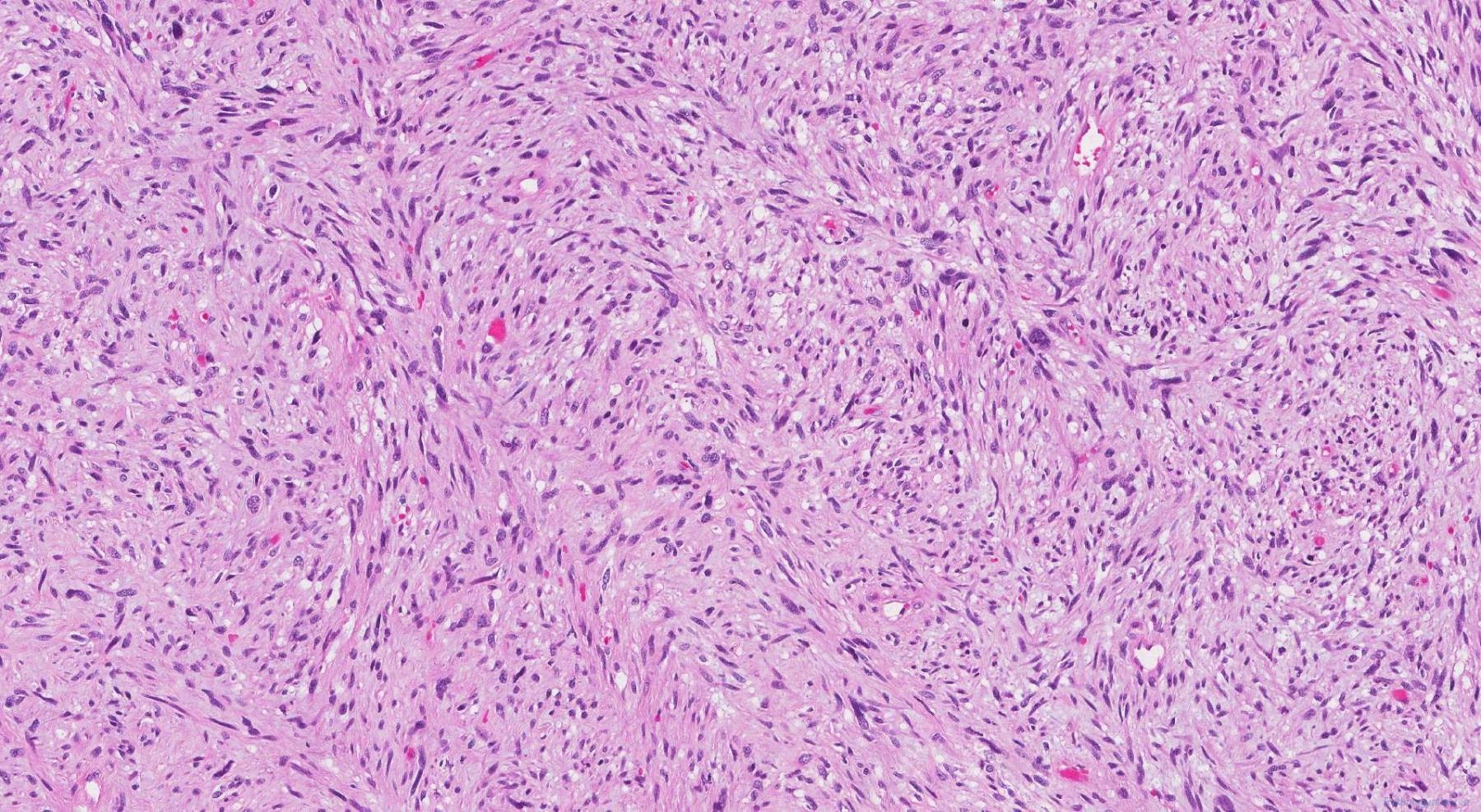 Malignant peripheral nerve sheath tumour | Atlas of Pathology