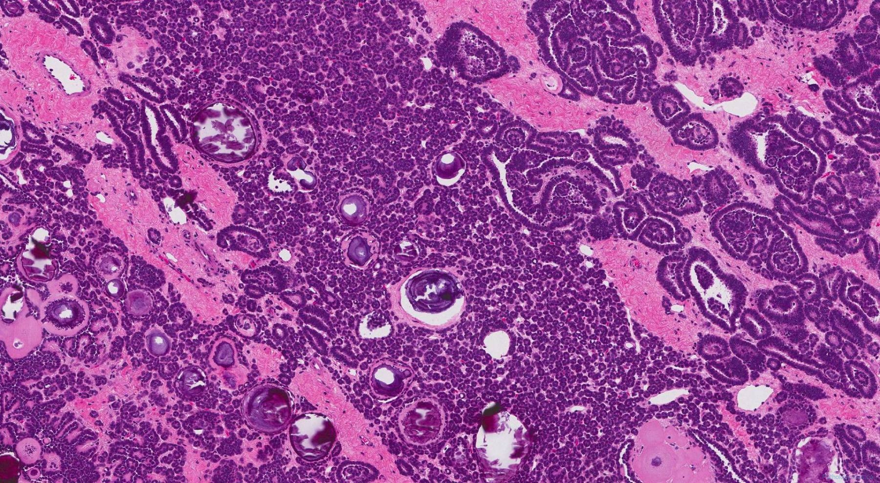 Metanephric adenoma | Ottawa Atlas of Pathology Metanephric adenoma | Ottawa Atlas of Pathology