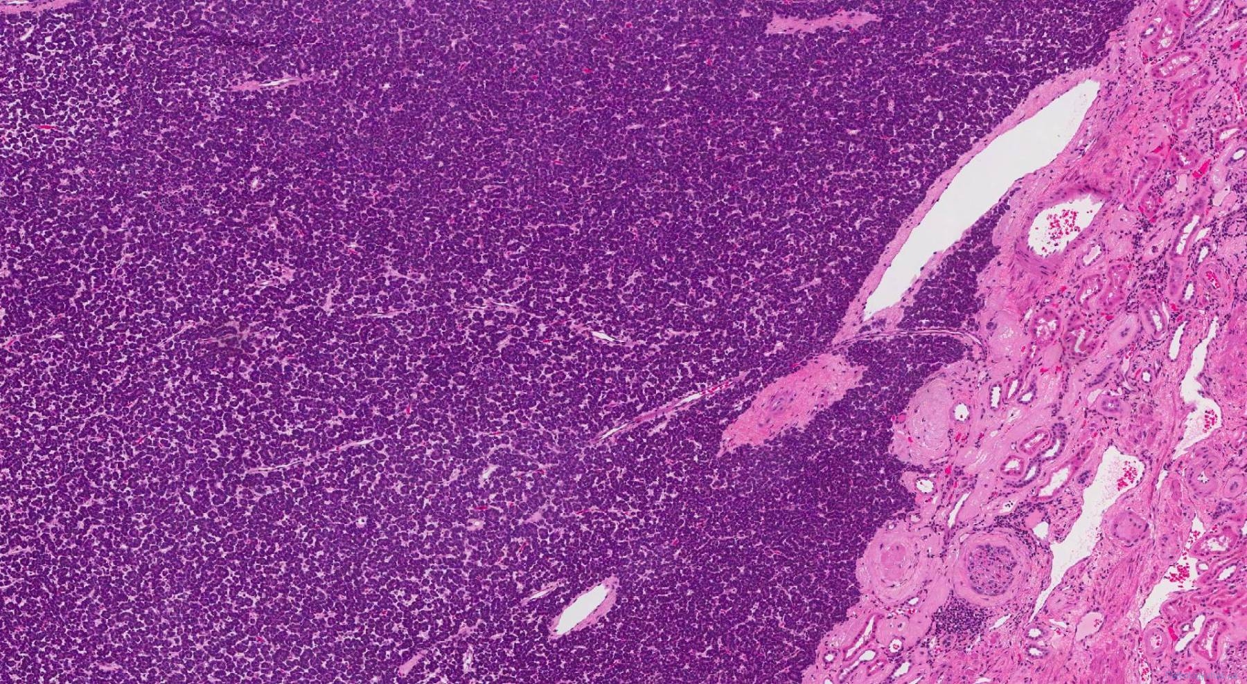 Metanephric adenoma | Ottawa Atlas of Pathology Metanephric adenoma | Ottawa Atlas of Pathology