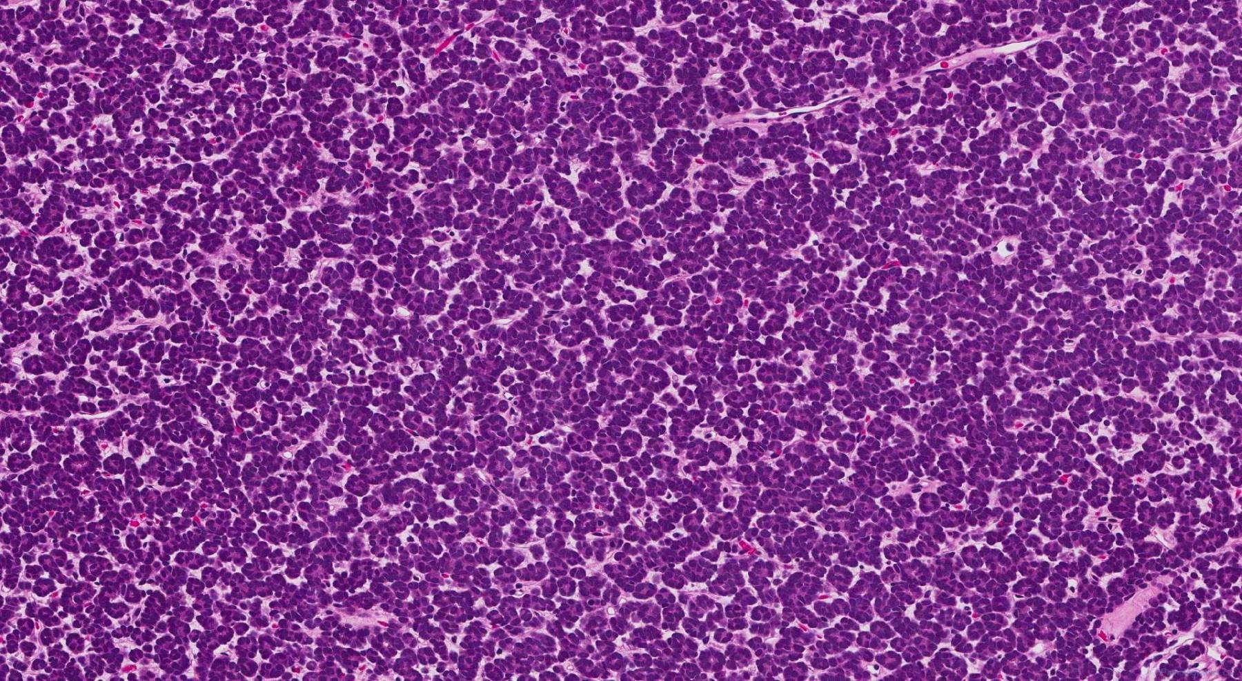Metanephric adenoma | Ottawa Atlas of Pathology Metanephric adenoma | Ottawa Atlas of Pathology