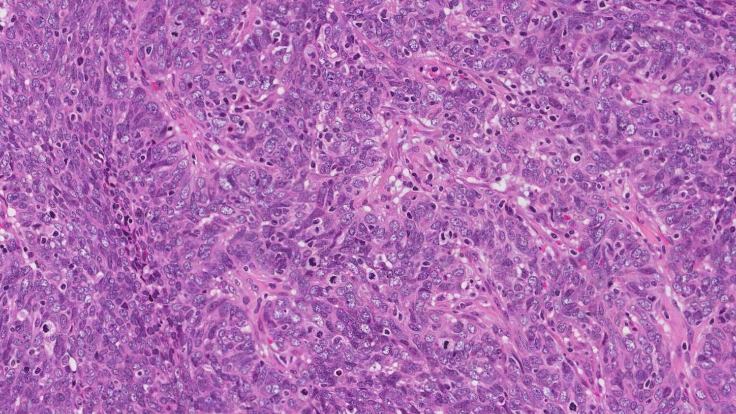 HPV-associated squamous cell carcinoma of the oropharynx | Atlas of ... HPV-associated squamous cell carcinoma of the oropharynx | Atlas of ...
