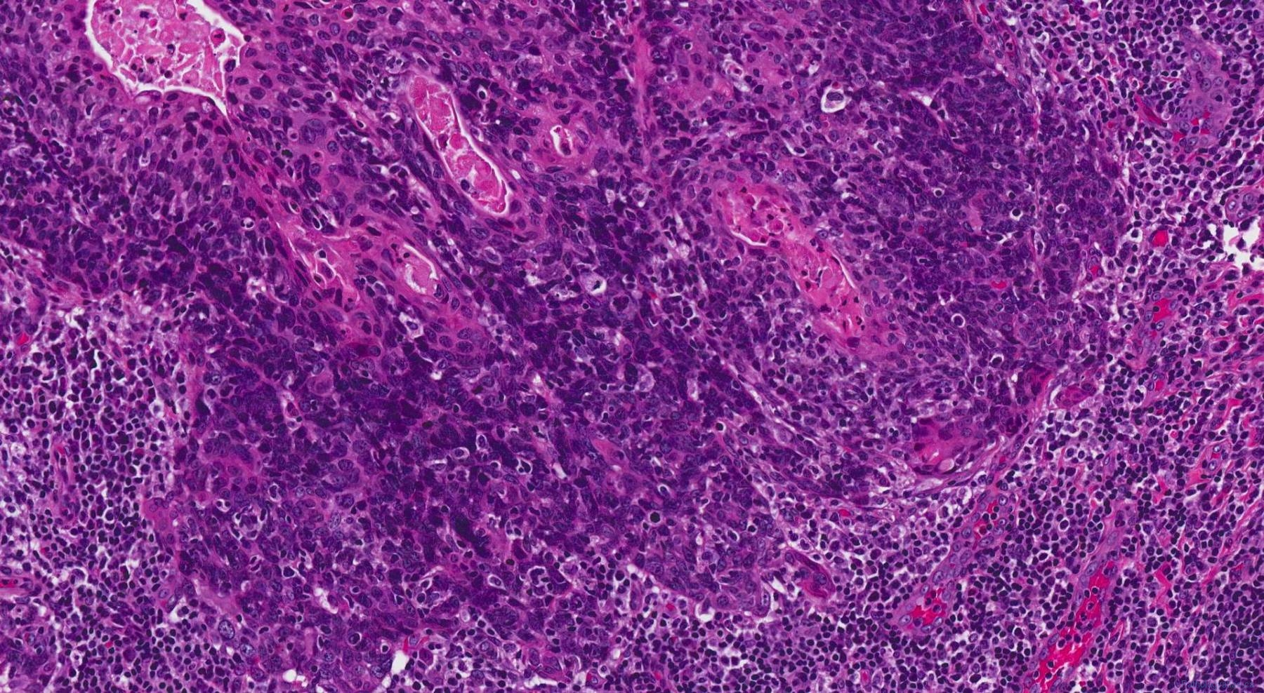 HPV-associated squamous cell carcinoma of the oropharynx | Ottawa Atlas ... HPV-associated squamous cell carcinoma of the oropharynx | Ottawa Atlas ...