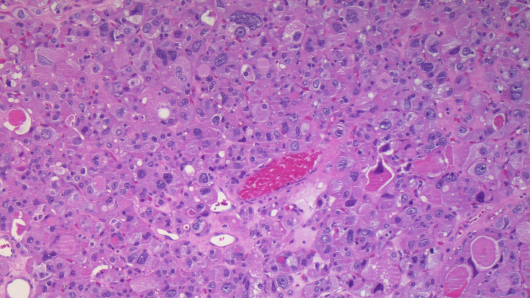 Oncocytic Adenoma Of The Thyroid Gland Atlas Of Pathology