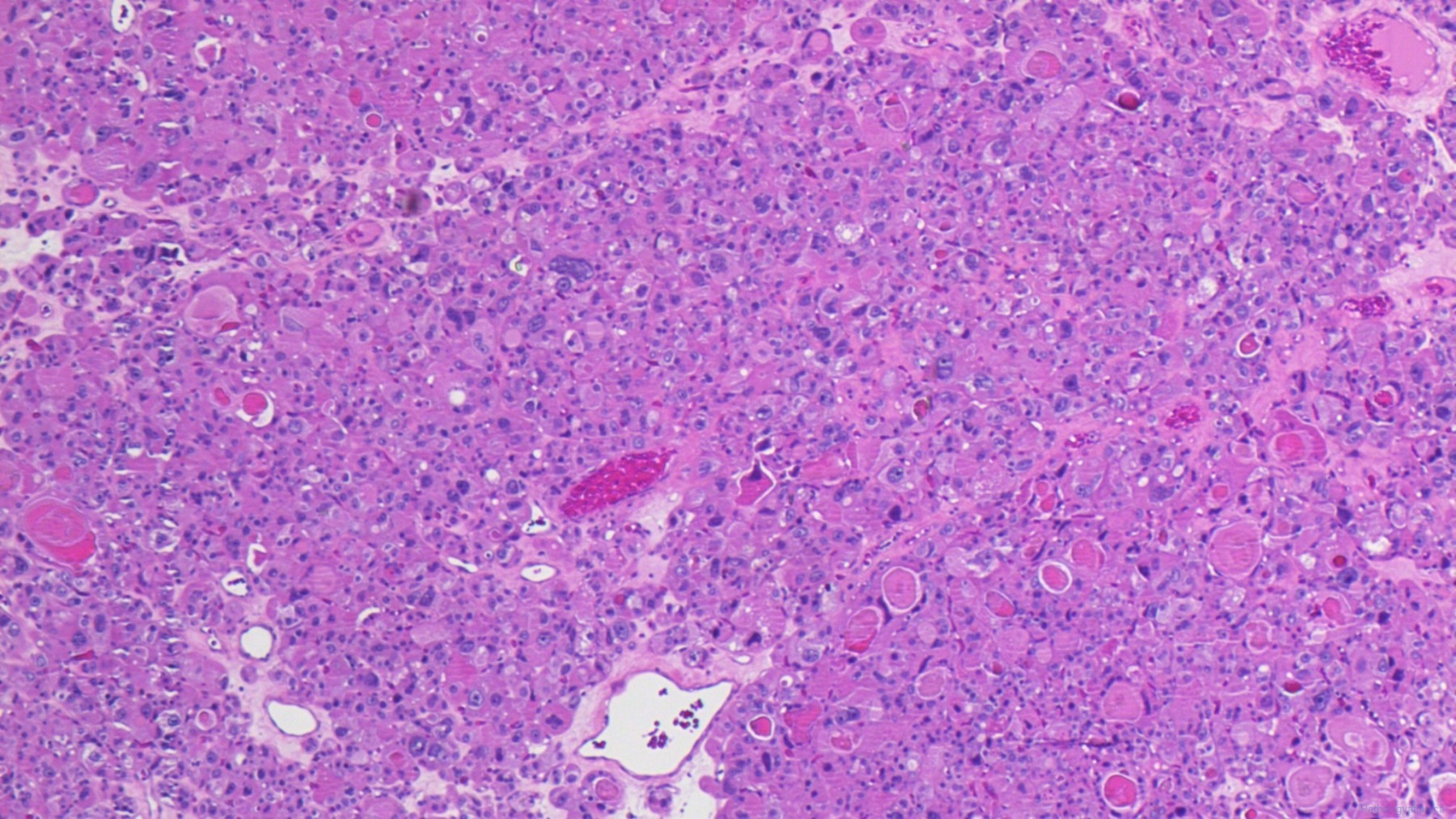 Oncocytic Adenoma Of The Thyroid Gland Atlas Of Pathology