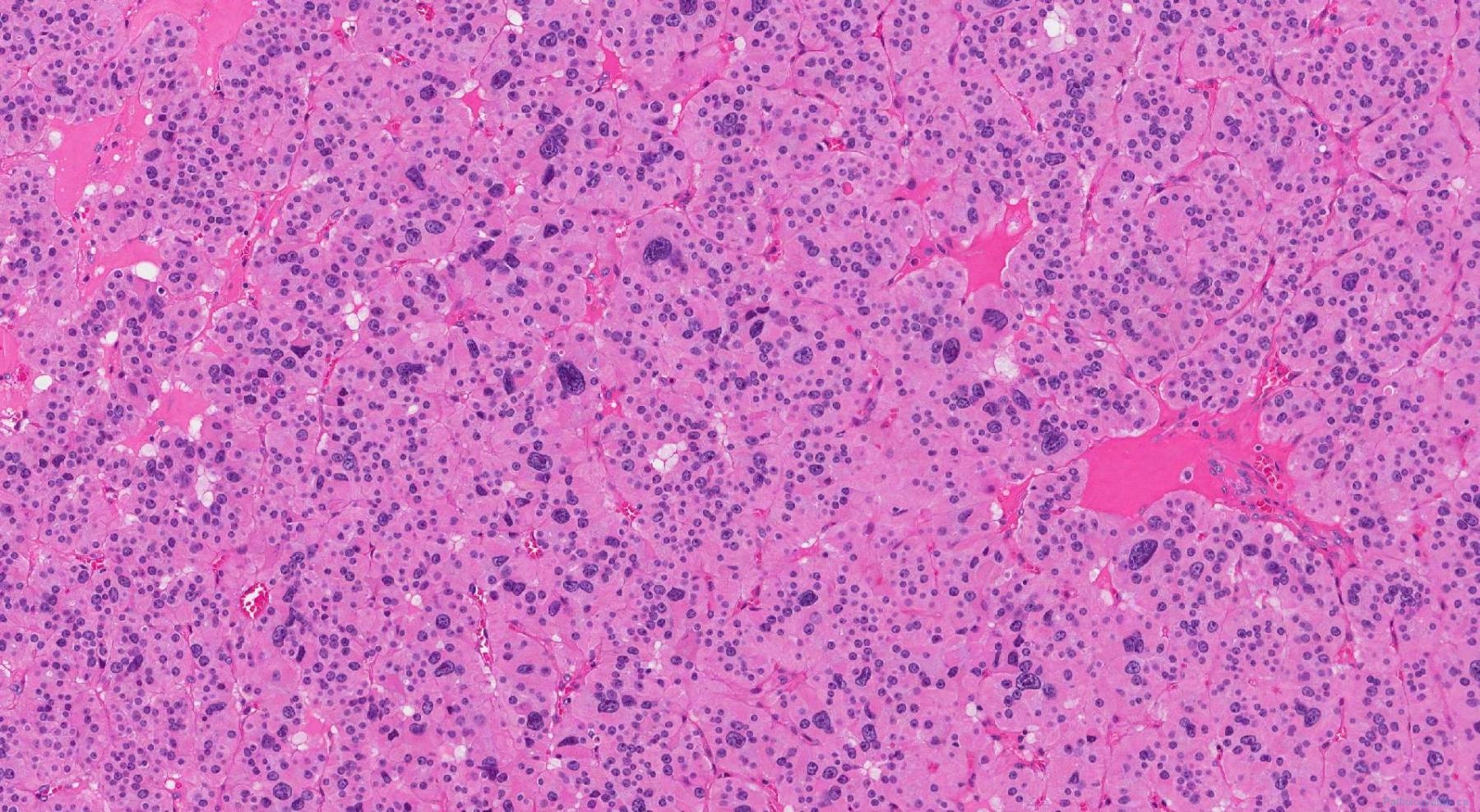 Oncocytic Carcinoma Of The Thyroid Gland Atlas Of Pathology