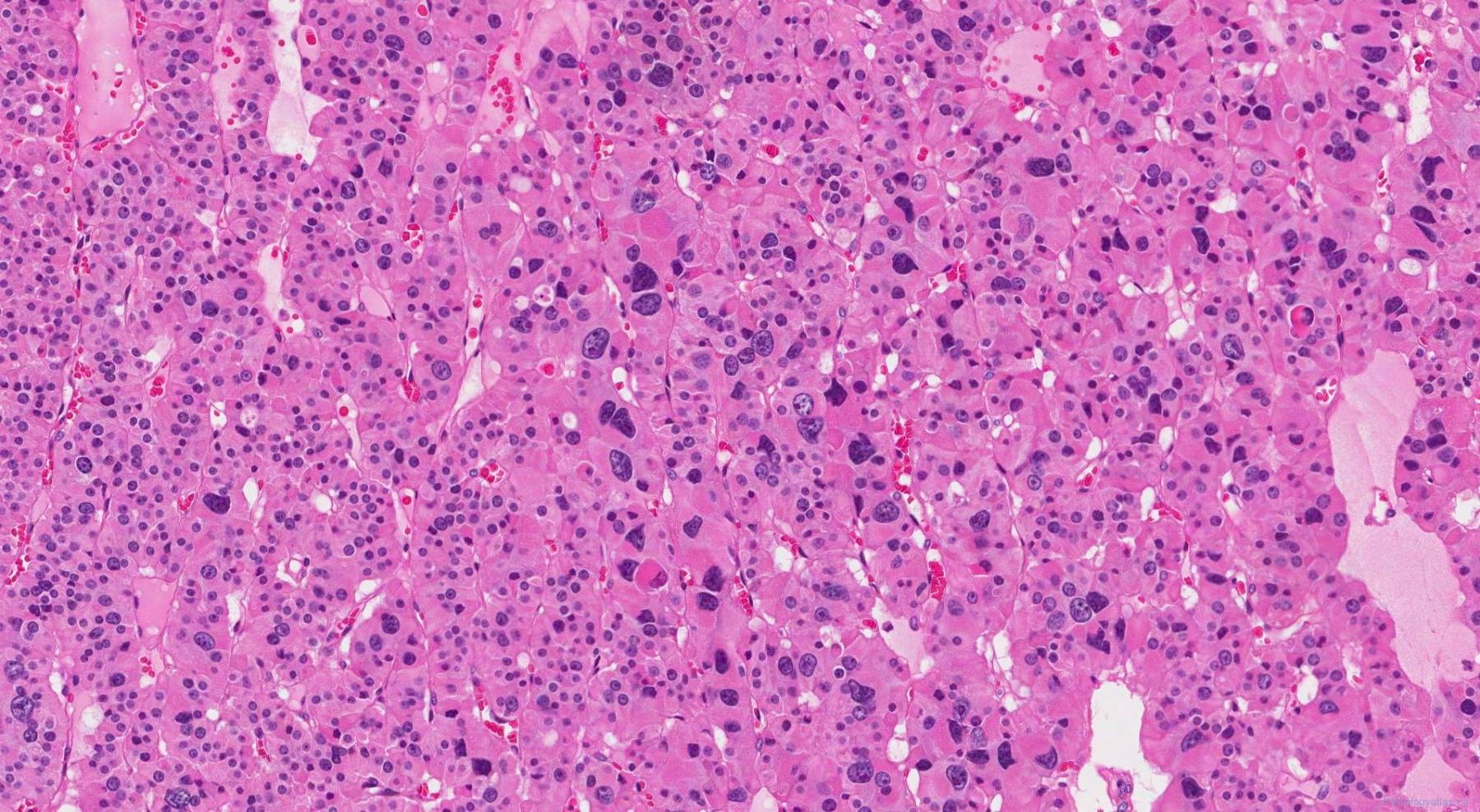 Oncocytic Carcinoma Of The Thyroid Gland Atlas Of Pathology