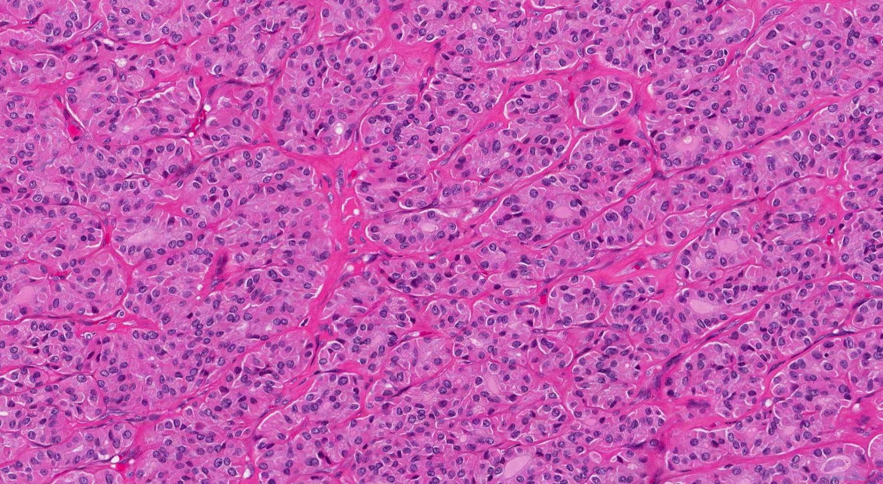 Oncocytic Carcinoma Of The Thyroid Gland Atlas Of Pathology