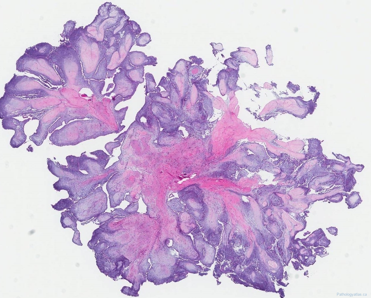 Papillary fibroelastoma | Atlas of Pathology Papillary fibroelastoma | Atlas of Pathology