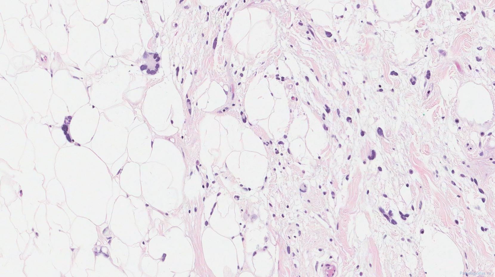 floret cells Archives | Ottawa Atlas of Pathology