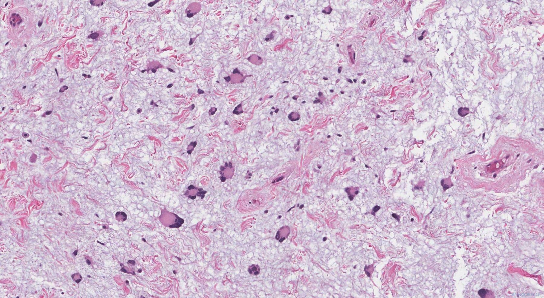 floret cells Archives | Ottawa Atlas of Pathology
