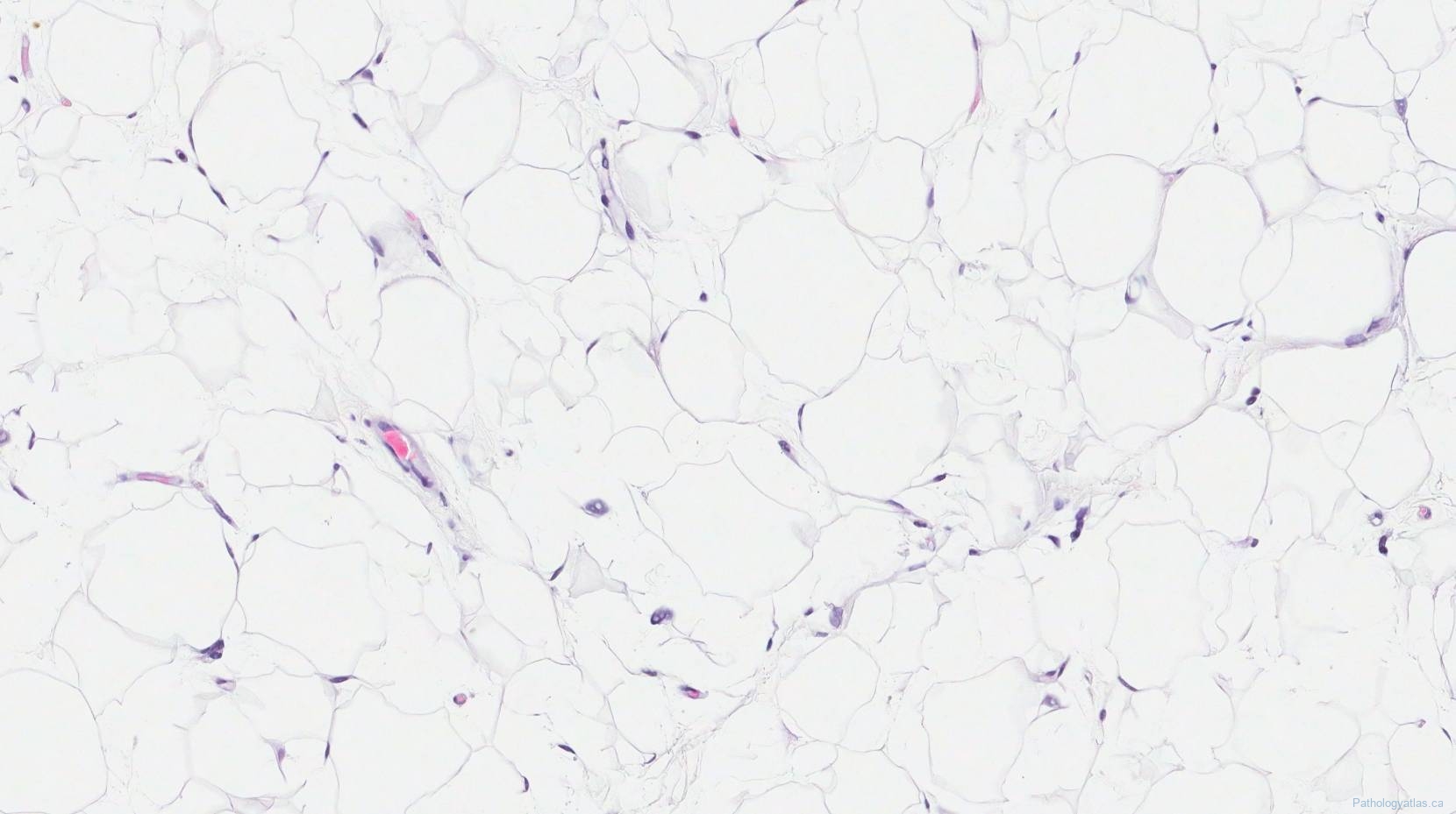 prolapsed orbital fat Archives | Atlas of Pathology