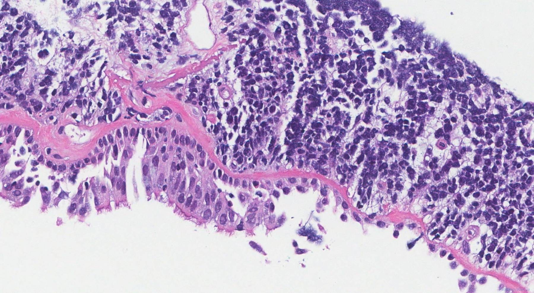 Small cell neuroendocrine carcinoma of the lung | Atlas of Pathology Small cell neuroendocrine carcinoma of the lung | Atlas of Pathology