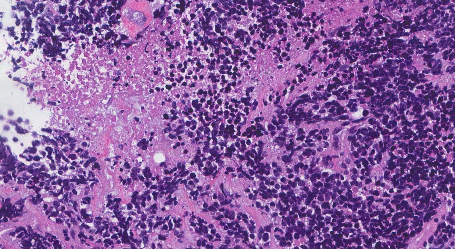 Small cell neuroendocrine carcinoma of the lung | Atlas of Pathology Small cell neuroendocrine carcinoma of the lung | Atlas of Pathology