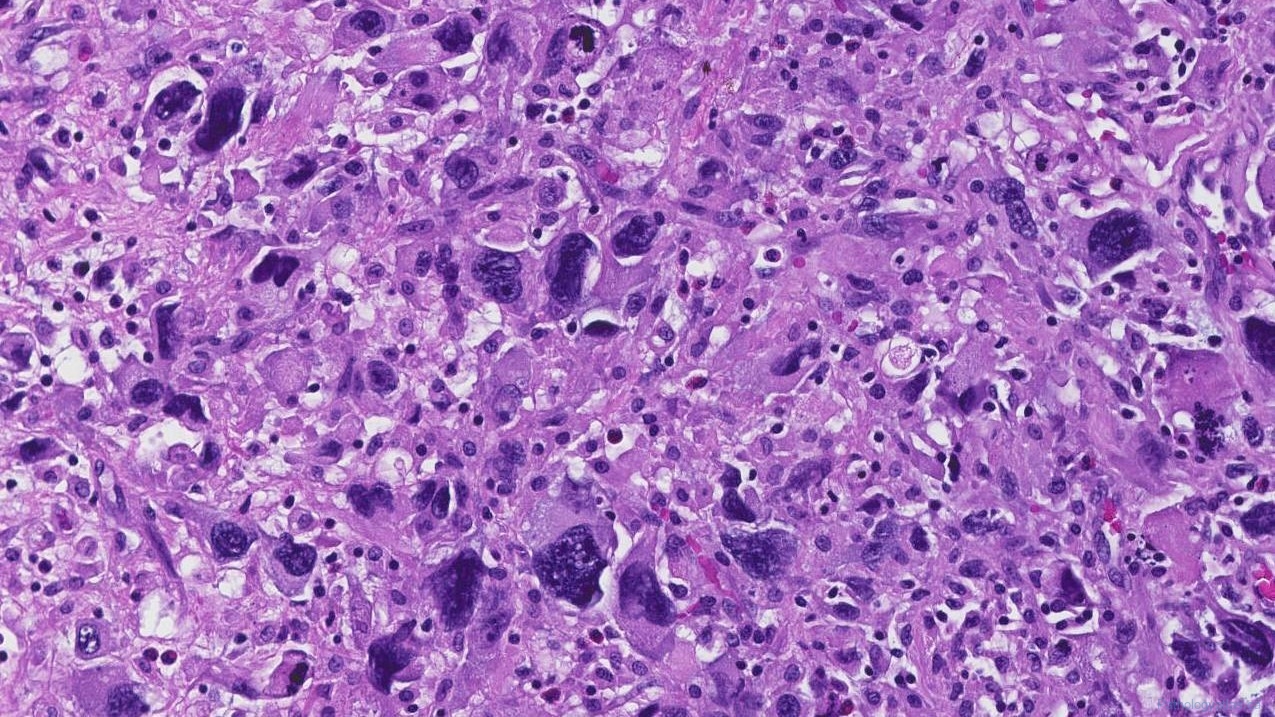 Undifferentiated Pleomorphic Sarcoma Atlas Of Pathology