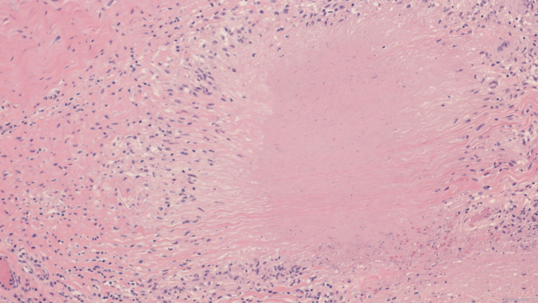rheumatoid-nodules-atlas-of-pathology