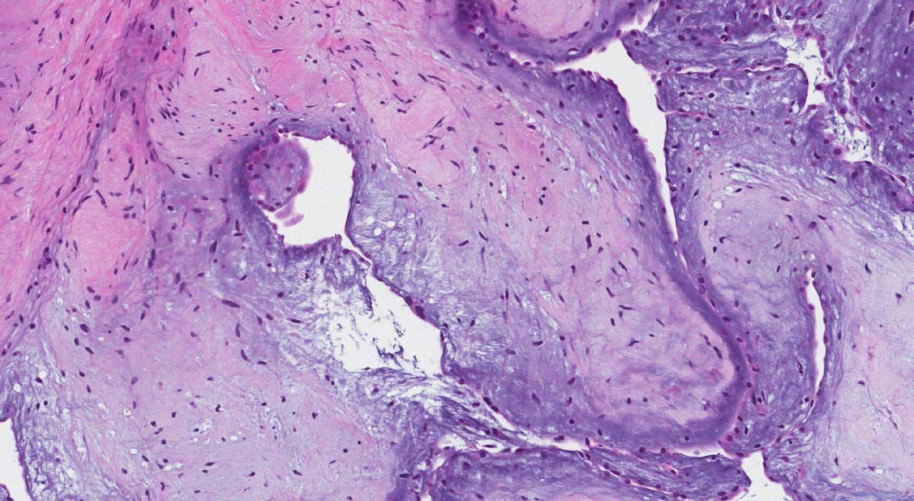 Papillary fibroelastoma | Ottawa Atlas of Pathology Papillary fibroelastoma | Ottawa Atlas of Pathology