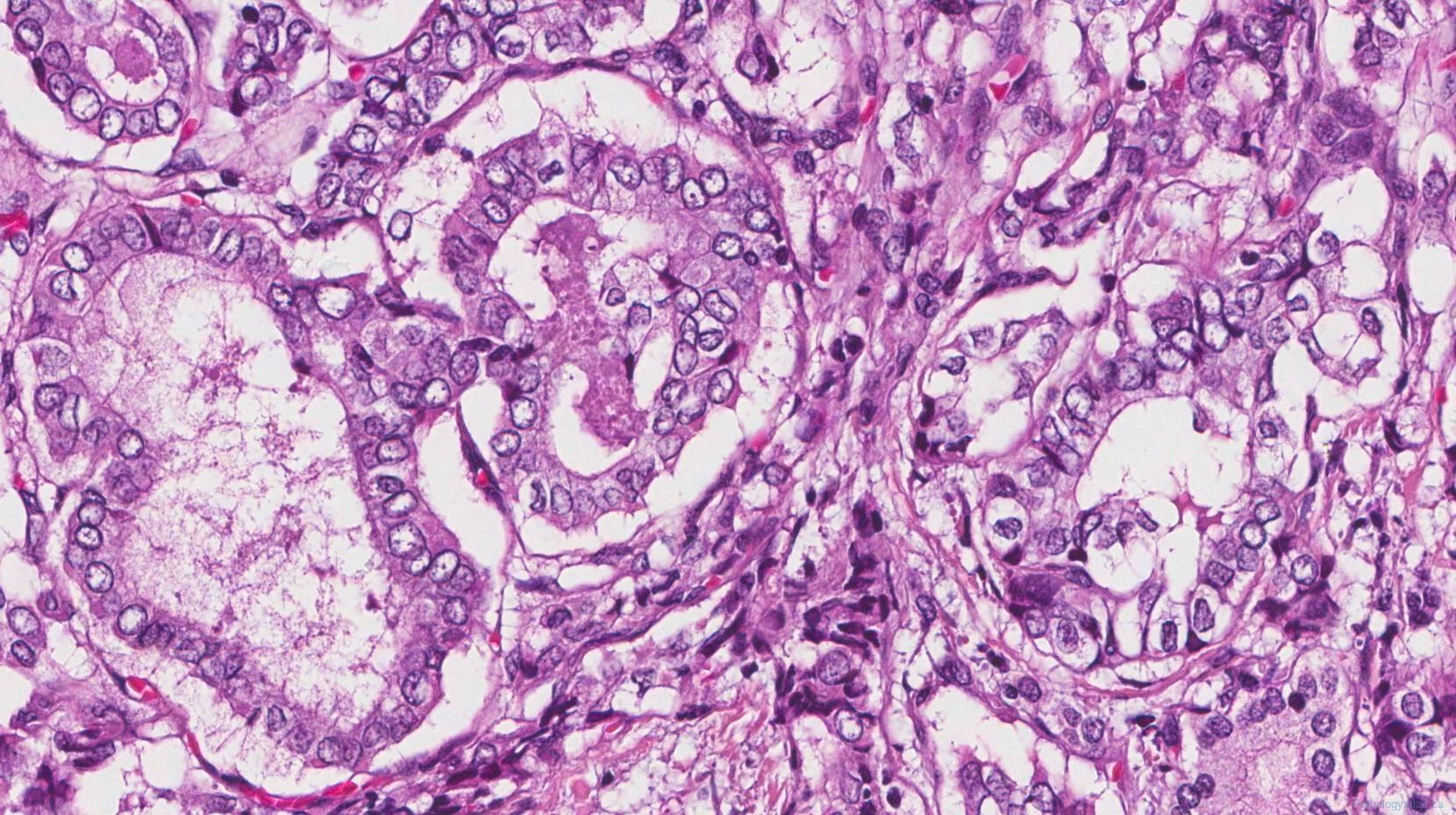 Papillary thyroid carcinoma | Ottawa Atlas of Pathology Papillary thyroid carcinoma | Ottawa Atlas of Pathology