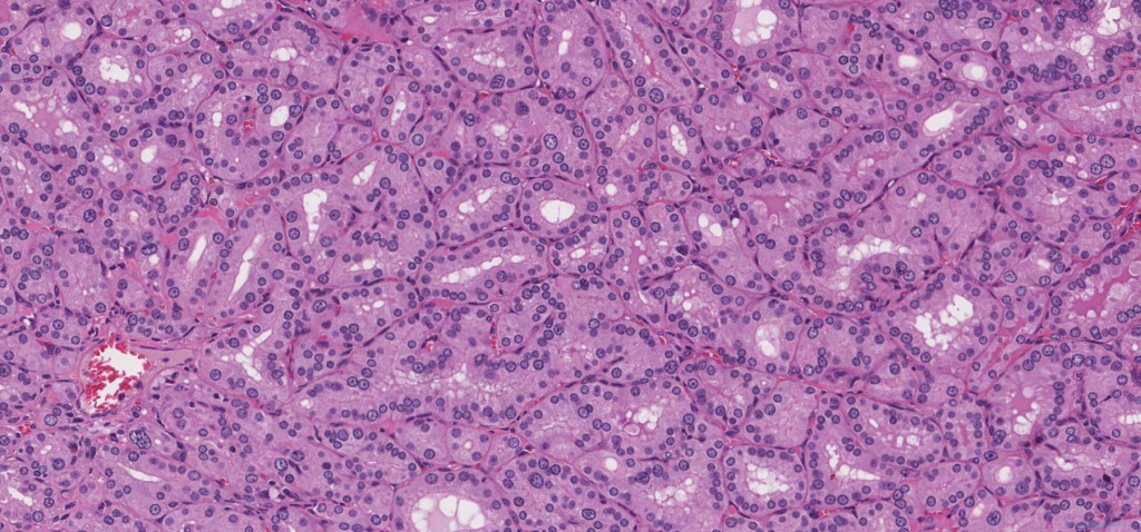 Diffuse papillary hyperplasia | Ottawa Atlas of Pathology Diffuse papillary hyperplasia | Ottawa Atlas of Pathology